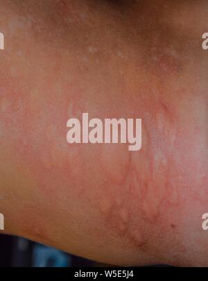 dry flaky skin on back of teenage girl Stock Photo - Alamy