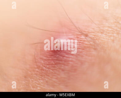 acne on inflamed human skin, teen body health and problems of red ...