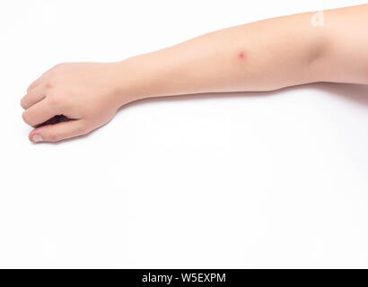 A big red pimple boil on a man s hand, acne treatment, white background ...
