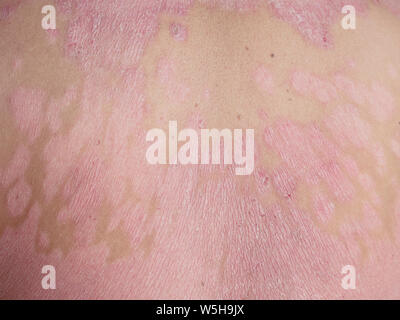 Diseases caused by abnormalities of the lymph and a skin disease Stock ...