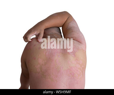 Men are using his hands to scratch the shoulder ulcers. Diseases caused ...