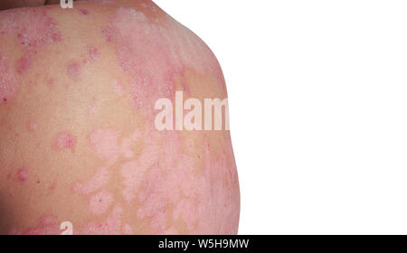 Close up of eczema or psoriasis on hand skin with open wounds peel and ...