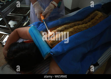 A Chinese doctor uses the ginger to apply the Governor Vessel ...