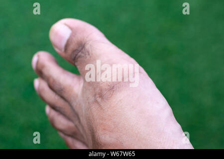 Varicose Veins on the Foot and Ankle Stock Photo - Alamy