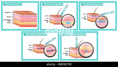Scientific medical illustration of types of injections illustration ...