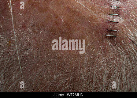 Squamous cell carcinoma Stock Photo - Alamy