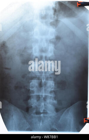 film x-ray L-S spine (lumbar-sacrum) : show normal human lumbar-sacrum ...