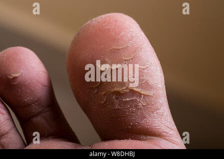 A skin disorder called Callus occurs on feet toe closeup Stock Photo ...