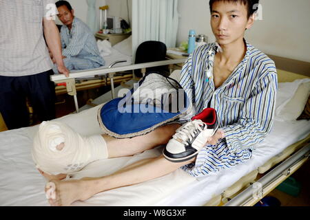 Liu Huichang who suffers from local gigantism sits on the bed after the ...
