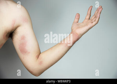 Man getting red skin rash at his body part - people with skin allergy ...