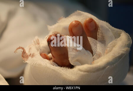 The new ring finger, left, on the left hand of A Yuan is pictured after ...
