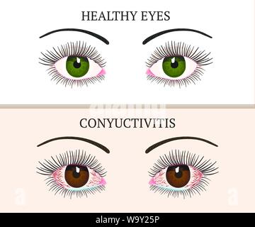 Conjunctivitis symptoms, pink eyes. Eye disease. Ophthalmology flat ...