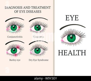 Eye disease. Most common eye problemc - conjunctivitis, glaucoma, dry ...