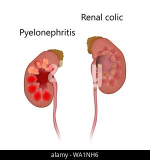 Pyelonephritis, comparison with kidney stones, illustration. The kidney ...