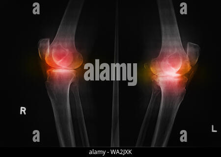 Osteoarthritis knee . film x-ray knee ( anterior - posterior and ...