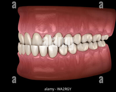 Underbite dental occlusion ( Malocclusion of teeth ). Medically ...