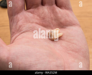 Pulled out wisdom tooth Stock Photo - Alamy