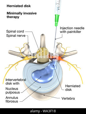 Spinal injection, illustration Stock Photo - Alamy