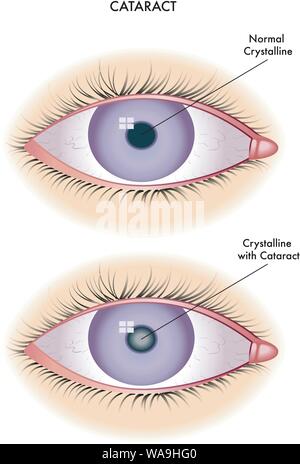 Cataract. Clouding of the lens, decrease of vision. Anatomical cross ...