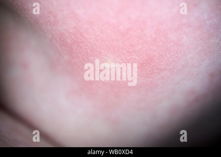 4 year old child red swollen cracked atopic dermatitis hands caused by ...