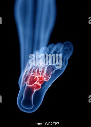 Foot pain, conceptual illustration Stock Photo - Alamy