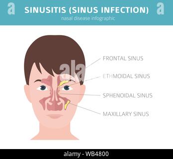Nasal diseases. Sinusitis, sinus infection diagnosis and treatment ...