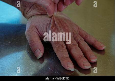 Skin turgor test Stock Photo - Alamy