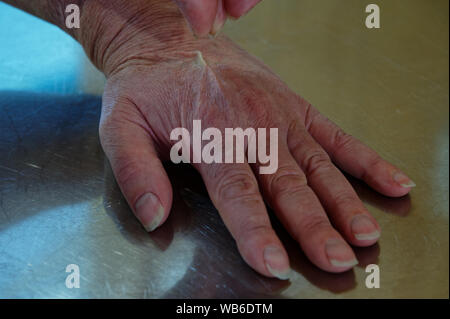 Skin turgor test Stock Photo - Alamy