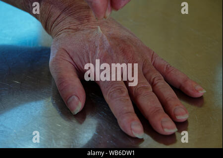 Skin turgor test Stock Photo - Alamy