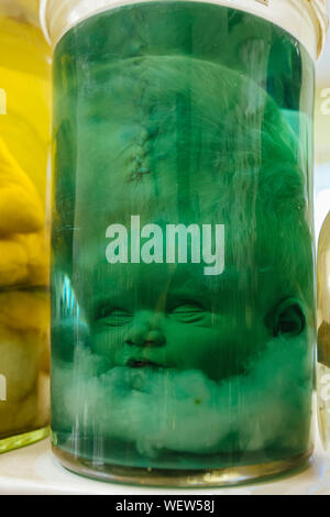 Hydrocephalus baby head in jar with formalin solution Stock Photo - Alamy