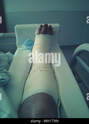 Broken leg with a plaster cast is resting, elevated on a settee with ...