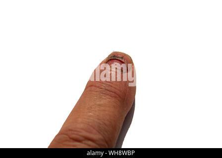 injured index finger and dying nail isolated on white background Stock ...
