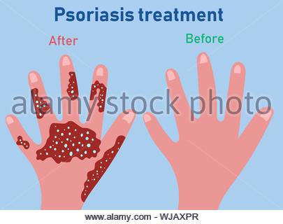 Hand with eczema Stock Photo: 69033927 - Alamy
