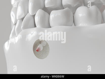 Root tip inflammation with apicectomy - 3D rendering Stock Photo - Alamy