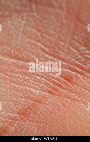 Skin close up. Dry human skin under microscope with eczema damage ...