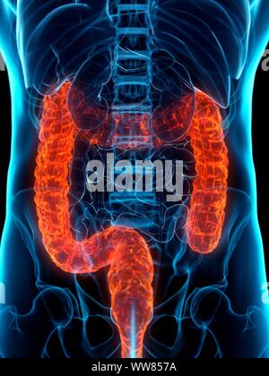 inside of an unhealthy colon Stock Photo - Alamy
