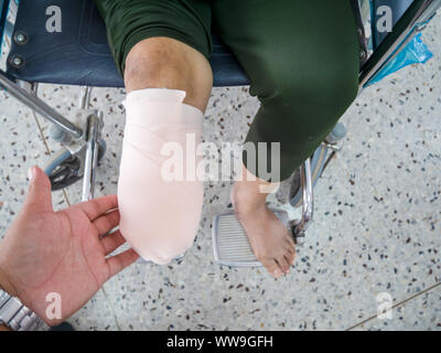 below knee stump bandaging, amputee BKA with prothesis preparing Stock ...