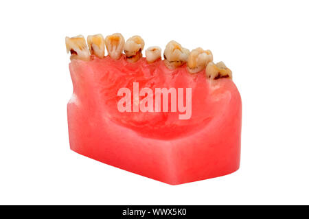 jaw affected tooth decay and dental handpiece Stock Photo - Alamy