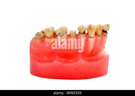 jaw affected tooth decay and dental handpiece Stock Photo - Alamy
