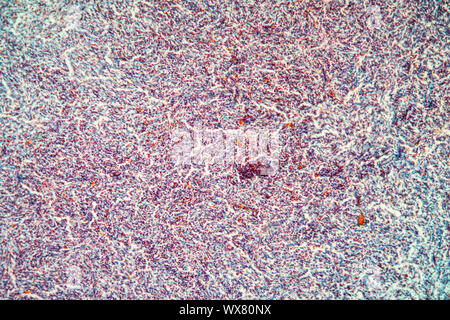 Gallbladder tumor tissue under the microscope 100x Stock Photo - Alamy