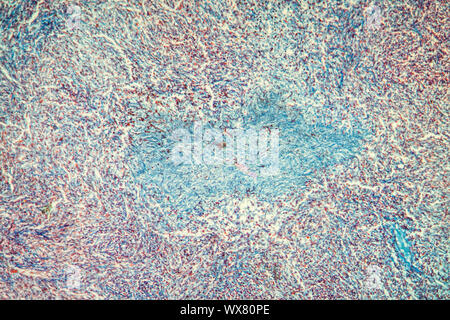 Gallbladder tumor tissue under the microscope 100x Stock Photo - Alamy