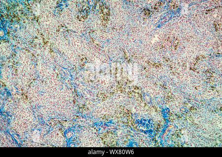 Foreign body granuloma tissue under the microscope 100x Stock Photo - Alamy