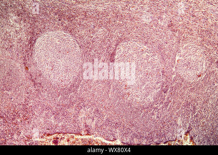 Tonsillitis diseased tissue under the microscope 100x Stock Photo - Alamy