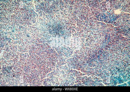 Gallbladder tumor tissue under the microscope 100x Stock Photo - Alamy