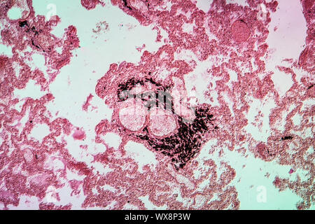 embolism after bone fracture 100x Stock Photo - Alamy