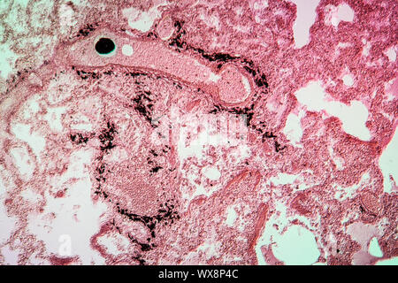 Embolism after bone fracture 100x Stock Photo - Alamy