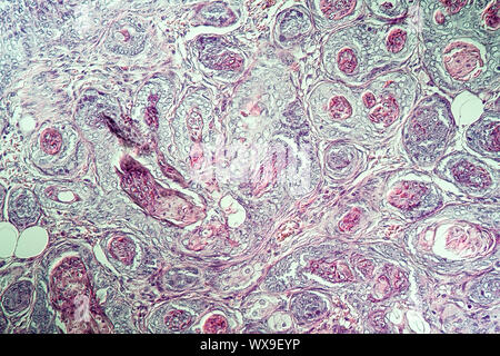 Spinaliom carcinoma in guinea pig, tissue 200x Stock Photo - Alamy