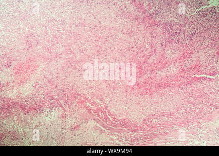 Gallbladder necrosis tissue under the microscope 100x Stock Photo - Alamy