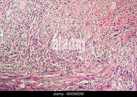 Gallbladder necrosis tissue under the microscope 100x Stock Photo - Alamy