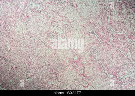 inflamed tissue under the microscope 100x Stock Photo - Alamy